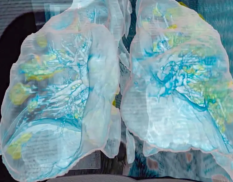 How Does Coronavirus Kill? Clinicians Trace a Ferocious Rampage Through ...